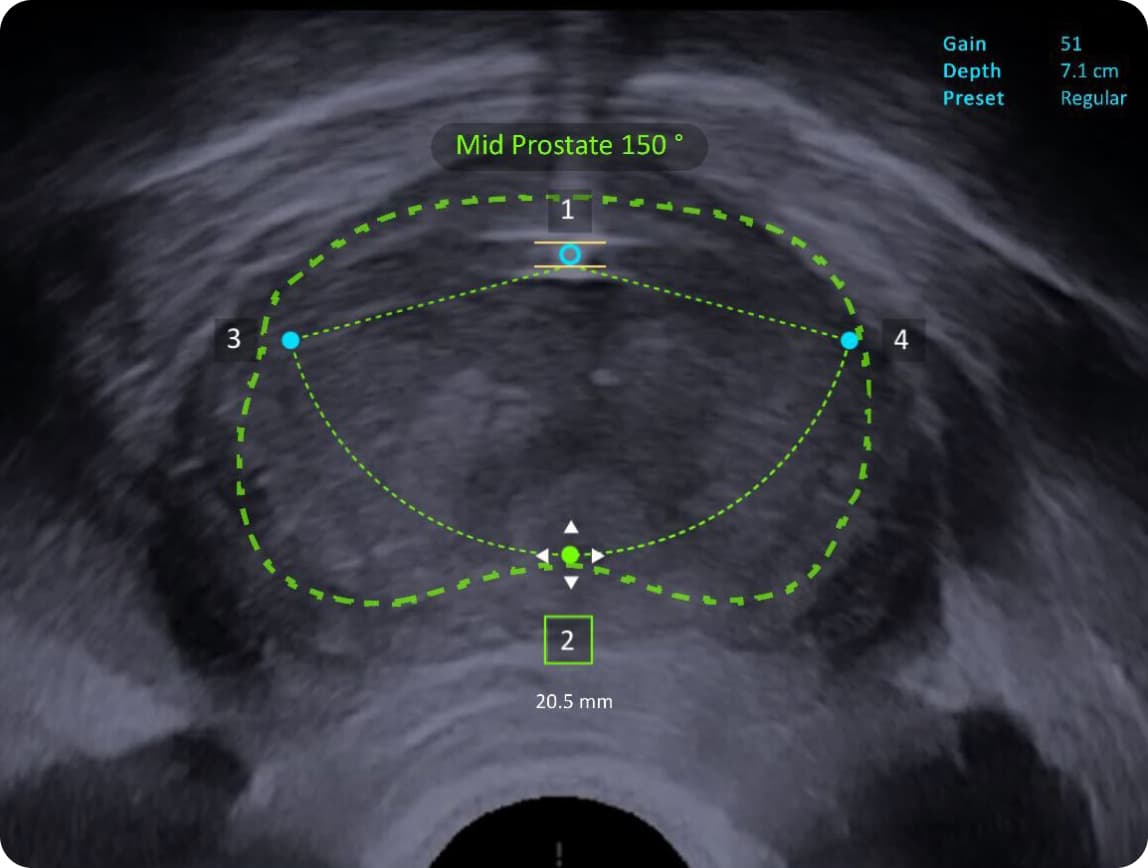 HYDROS Robotic System for BPH Treatment | PROCEPT BioRobotics