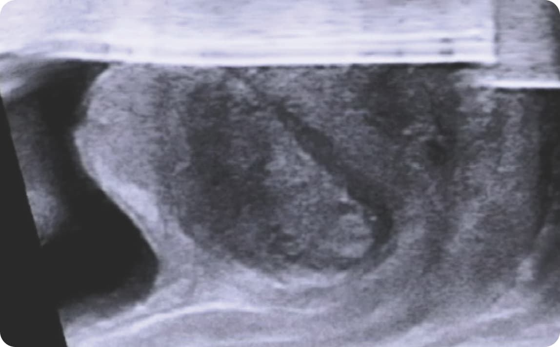 AquaBeam Robotic System for BPH Treatment | PROCEPT BioRobotics