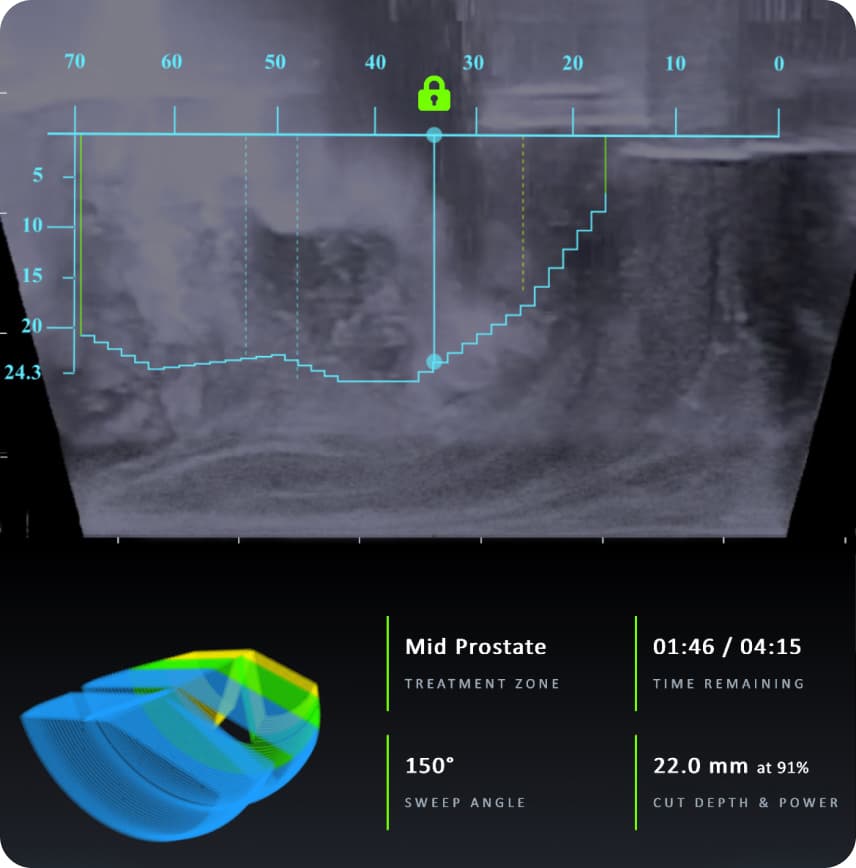 HYDROS Robotic System for BPH Treatment | PROCEPT BioRobotics